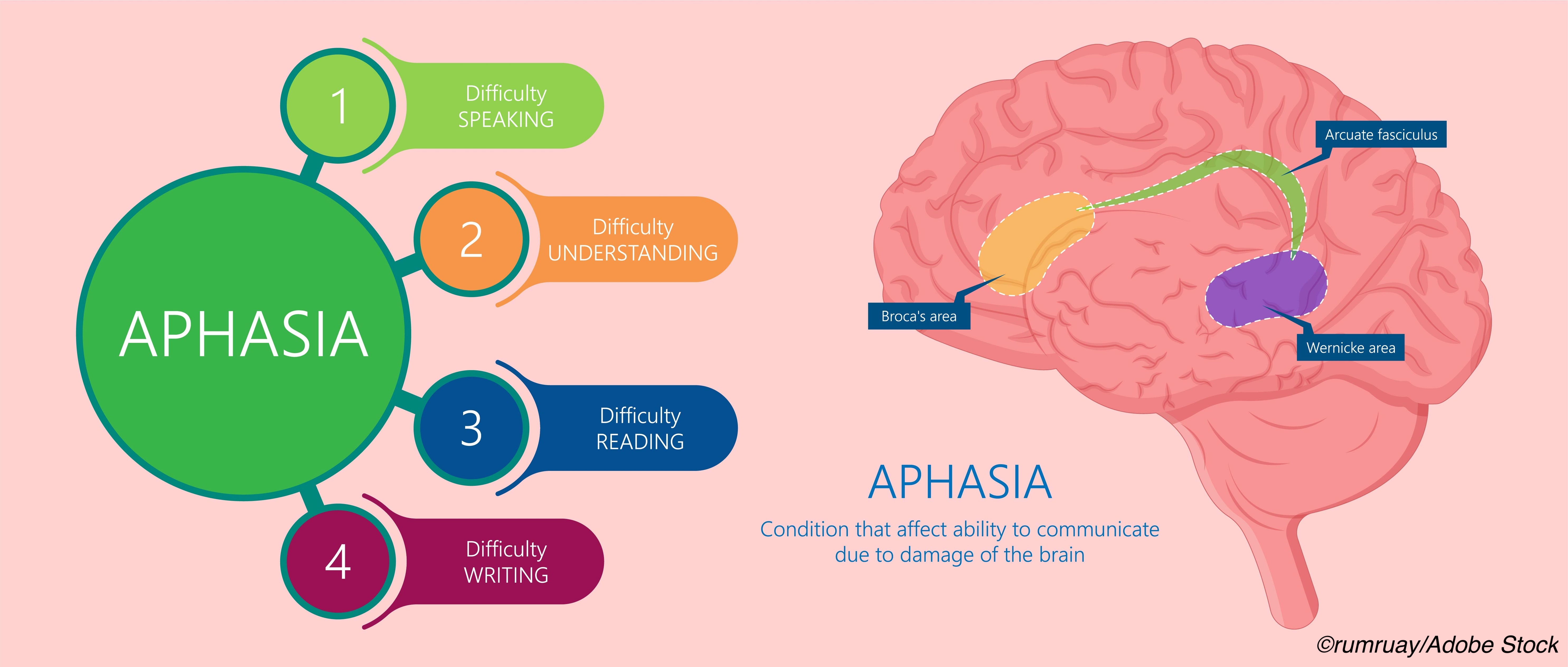 Memory Preserved In Primary Progressive Aphasia With Alzheimer s