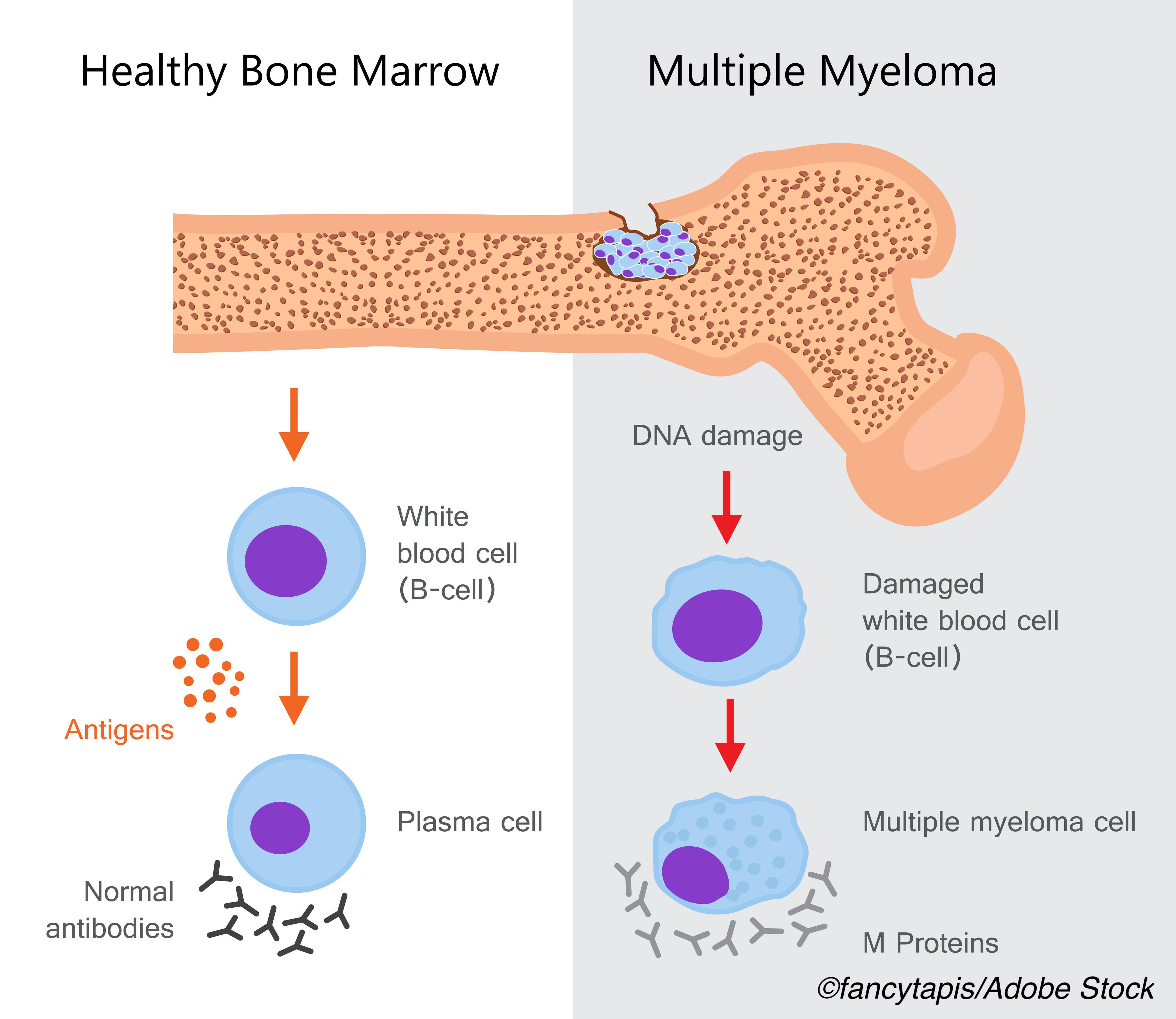 MGUS Patients At Risk For Progression To Multiple Myeloma Physician s